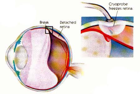 RETINAL CRYOPEXY – Eagleview Eye Clinic
