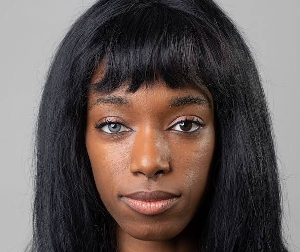 HETEROCHROMIA IRIDIUM – Eagleview Eye Clinic
