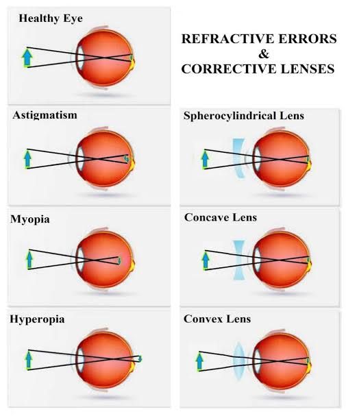 TYPES OF LENSES ACCORDING TO REFRACTIVE ERROR. – Eagleview Eye Clinic